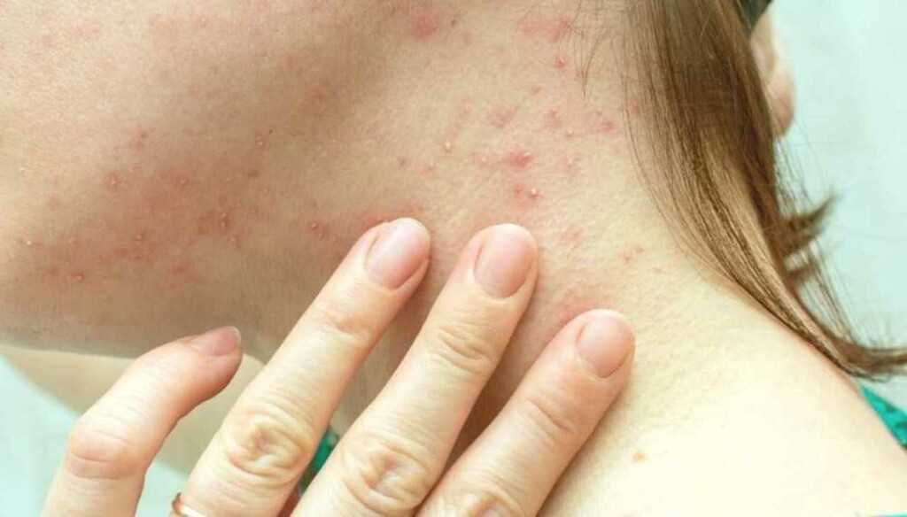 Valutare la gravità del vaiolo delle scimmie: nuovi risultati - Napoli ZON